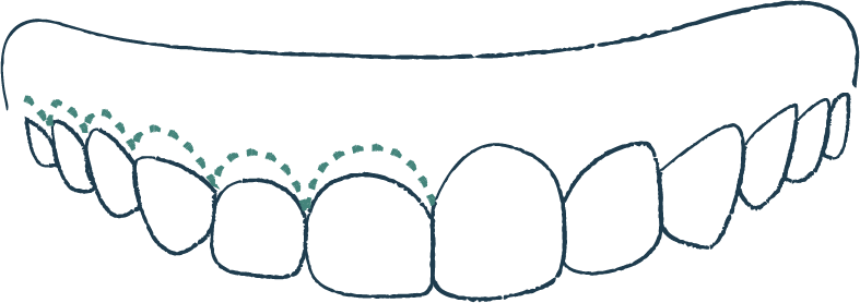 Gum Shaping in Wichita | Improve Gum LInes & Smile Shape